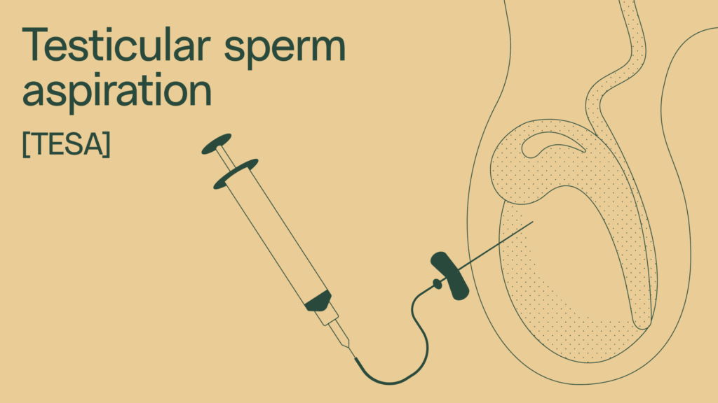 Testicular Sperm Retrieval Options — Male Fertility Legacy