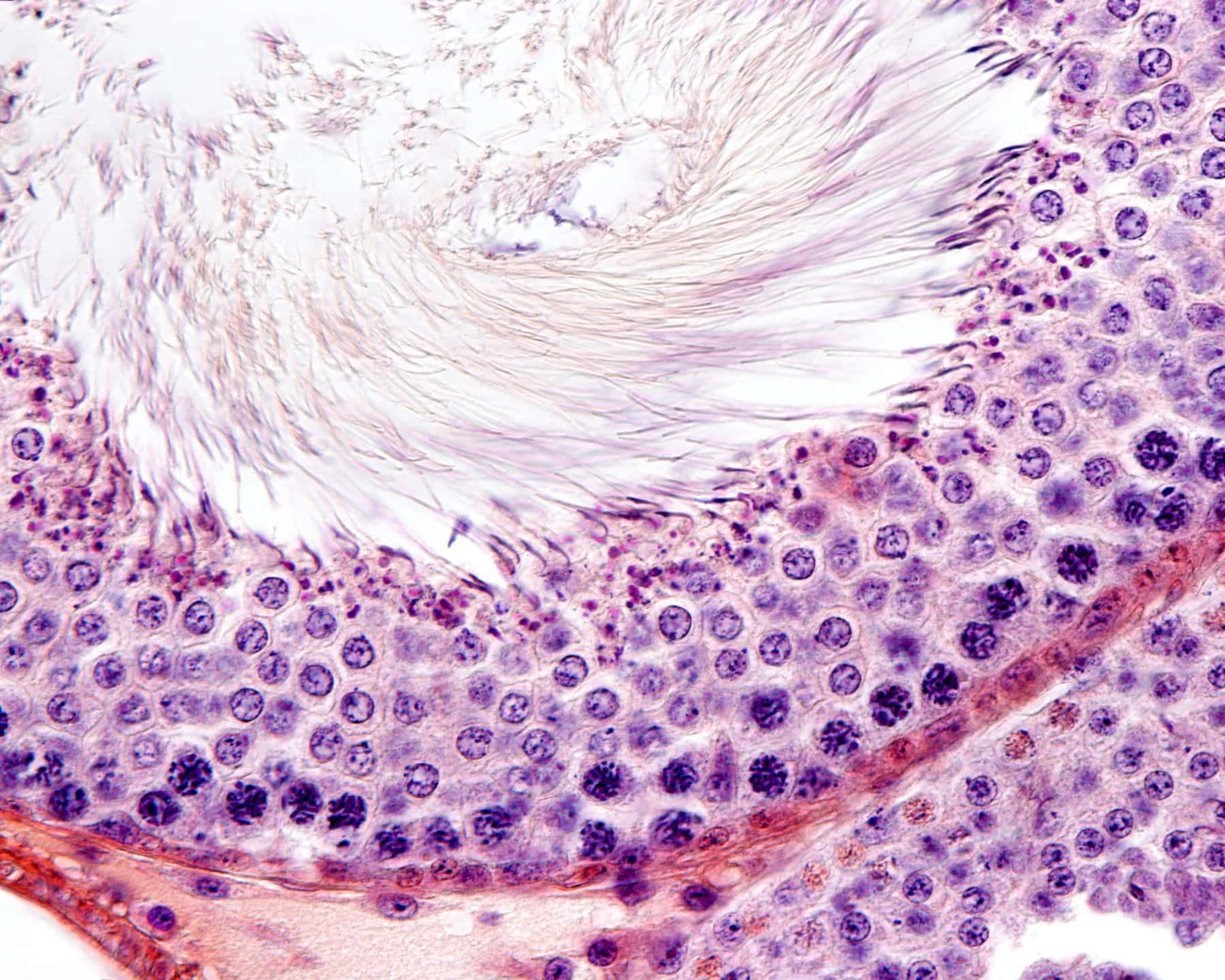 Sertoli cell-only syndrome | Legacy